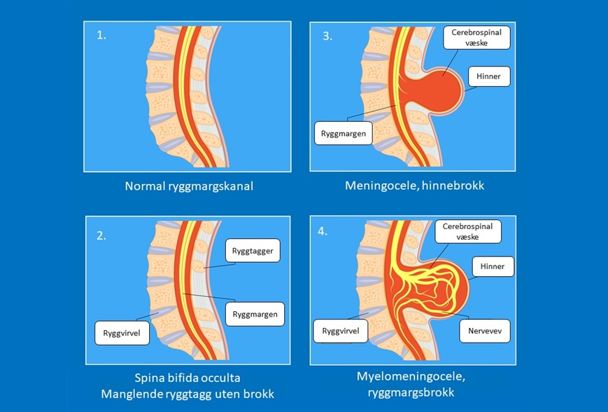 Medisinske forhold ved ryggmargsbrokk - Sunnaas sykehus HF